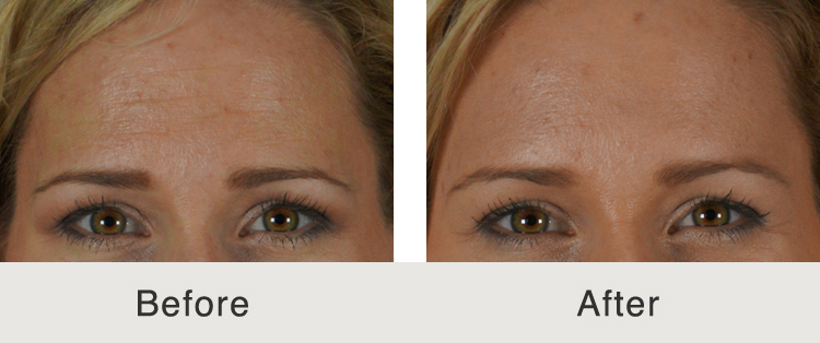patient-before-and-after-botox-images-carolina-facial-plastic-surgery